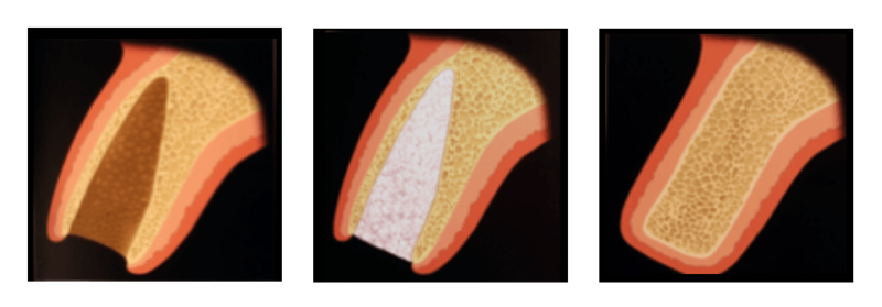 Bone Grafts - Preston Hollow Periodontal